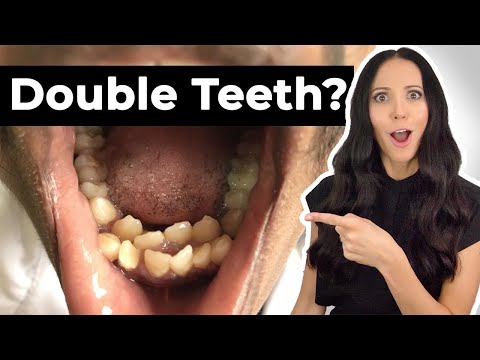 Why 3.8% of People Have Extra Teeth