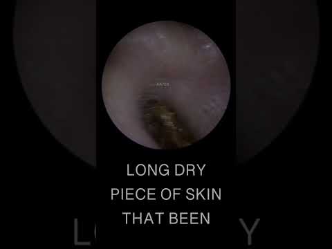 DRY SKIN RIBBON REMOVAL