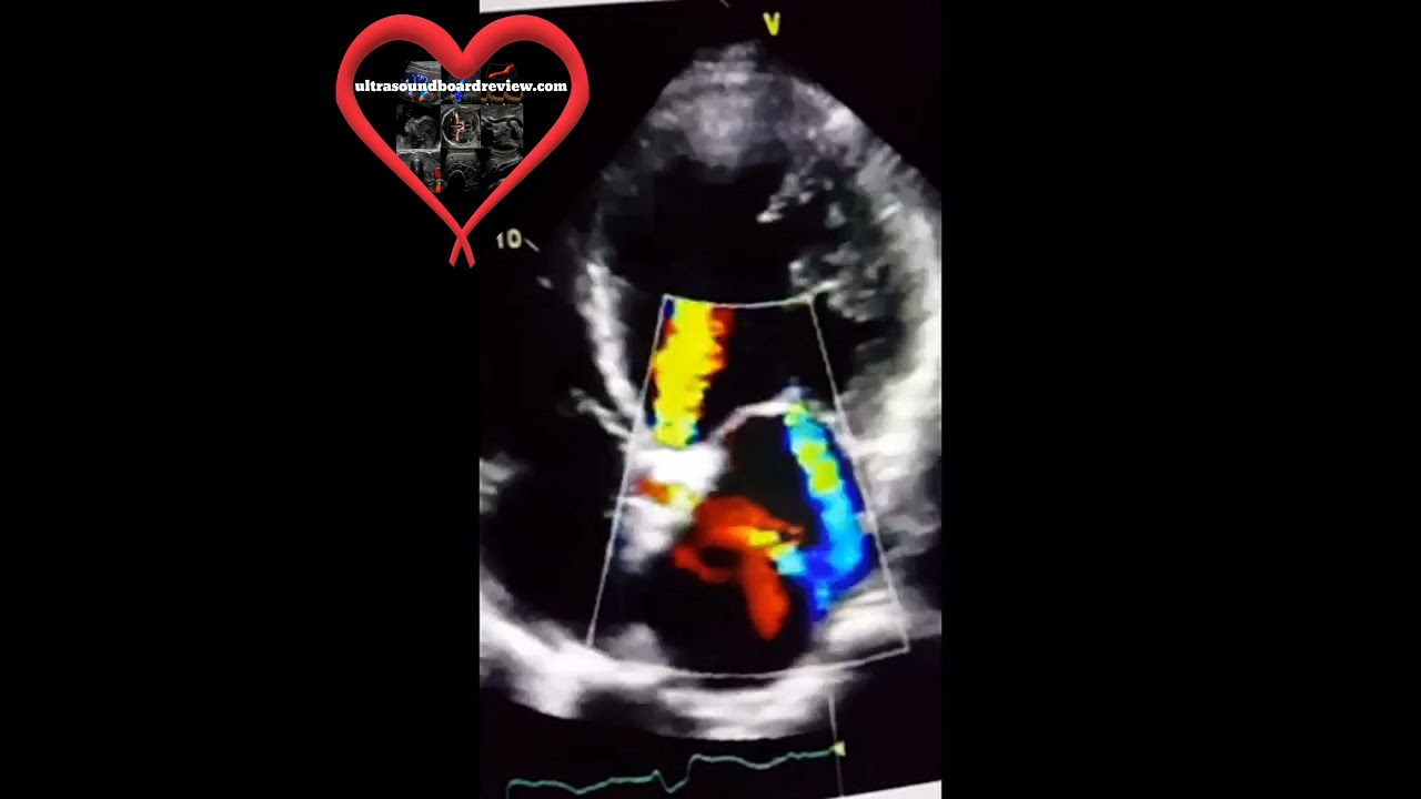 Bullet Through The Heart Echocardiography