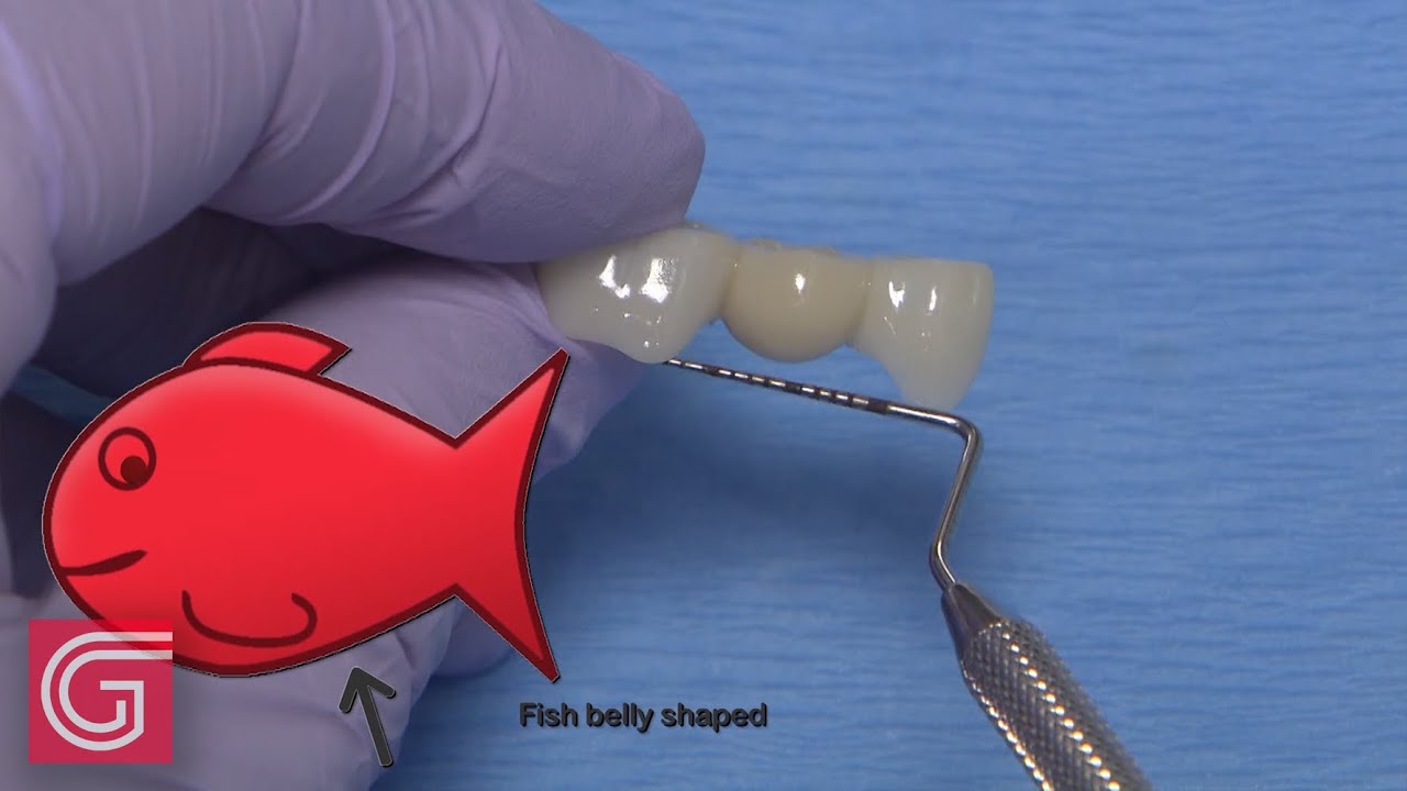 Top 5 Pontic Designs for 3-Unit #BioTemps Provisional Bridge