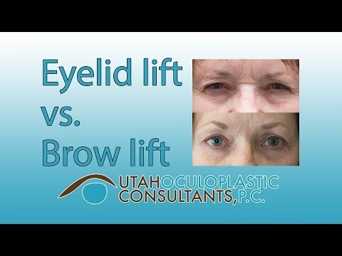 Eyelid lift vs brow lift