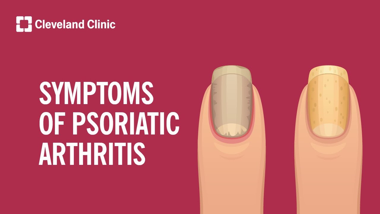 7 Signs of Psoriatic Arthritis