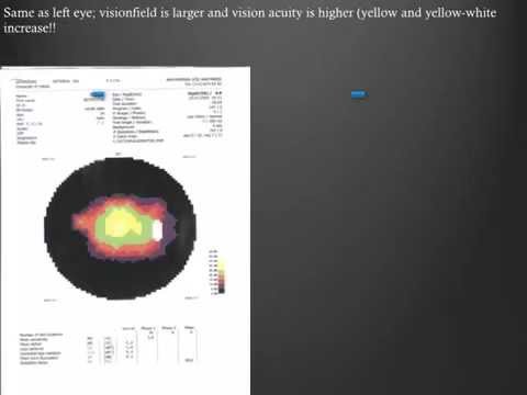 Proof (Visual Field Test Results)