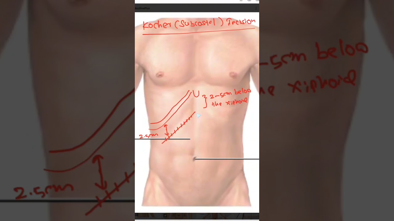 Kosher (Subcostal) incision #anatomy #learnanatomy