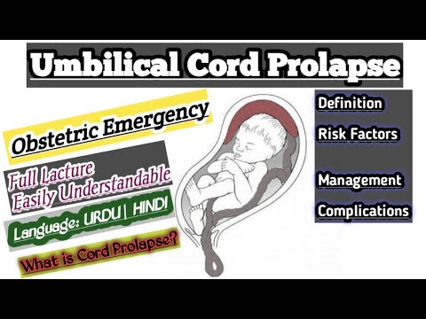 umbilical cord prolapse in urdu/ hindi || cord prolapse