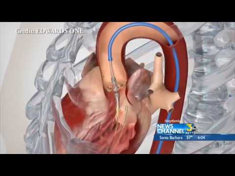 Cottage Health - One Year Anniversary of Successful TAVR Surgeries