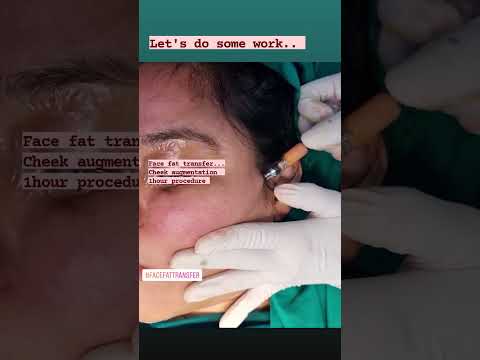 Facial Fat Grafting #facialaesthetics #skincare #shorts