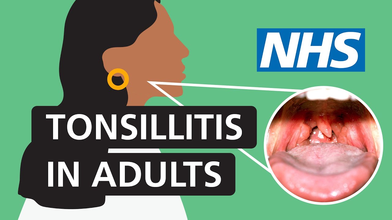 Tonsillitis in adults: Symptoms and treatment | NHS