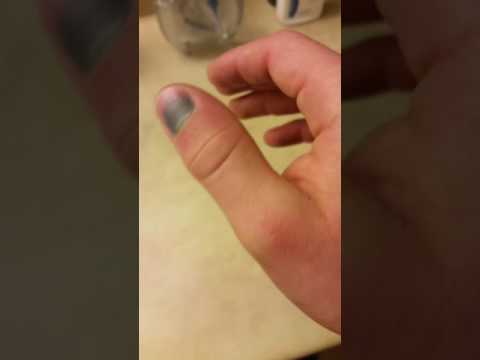 Distal Phalanx fracture right thumb