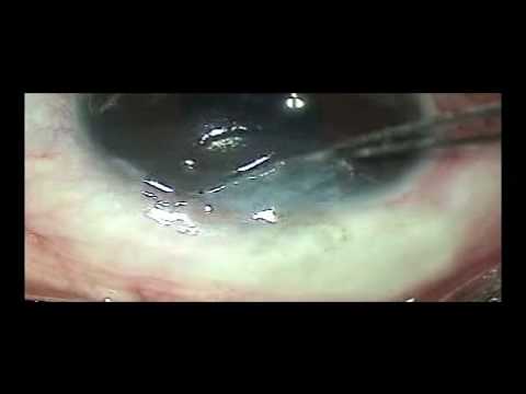 Corneal disecting bleb surgery by R.A.Perez-Grossmann
