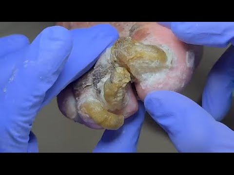 Toenail cleaning (nail fungus) - Nails1881 - Ep2