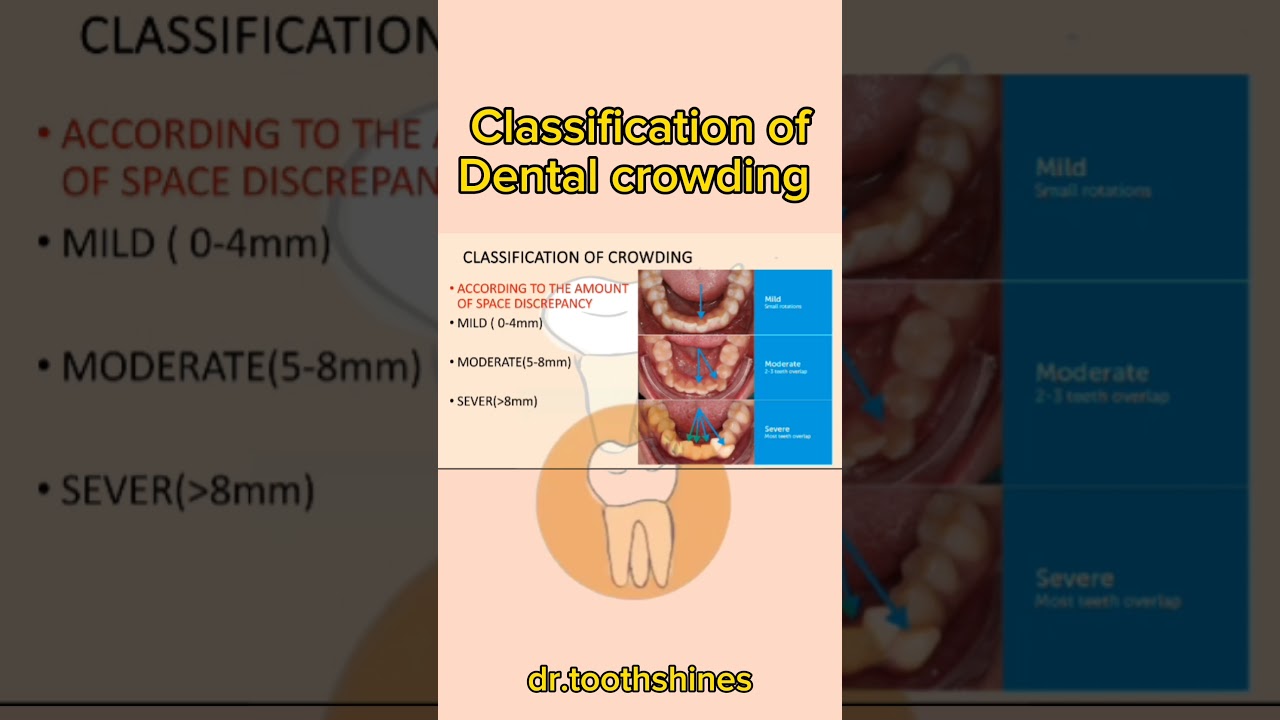 Classification of dental crowding #dentistry #malocclusion #generaldentist #dentist