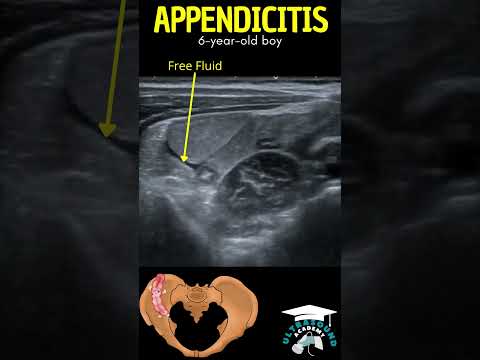 Appendicitis in a 6-Year-Old: 40-Second Ultrasound Case Study #ultrasound #appendicitis