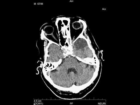 Left MCA distal main stem infarct CT Brain
