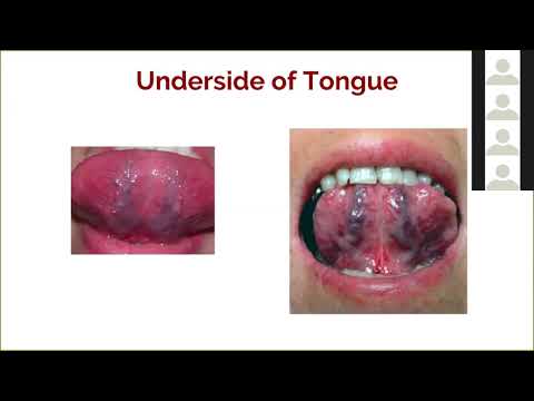 Art of Ayurveda Tongue Diagnosis 6 of 9: Under the Tongue / Sublingual Veins