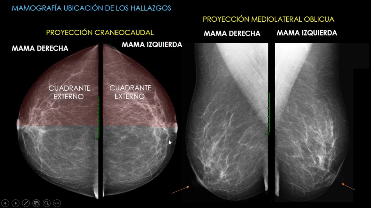 Mamografía Parte 1