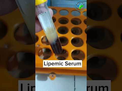 Lipemic Serum | hyperlipidemia #medicallaboratory #bloodtest #medicallab