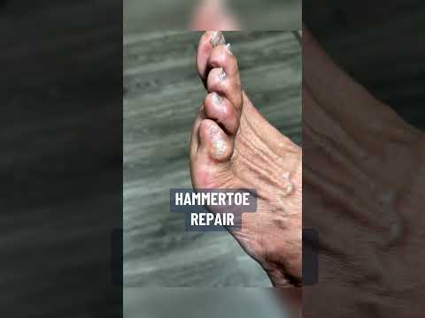 Hammertoe Repair #podiatry #feet #footcare #hammertoe #hammertoesurgery