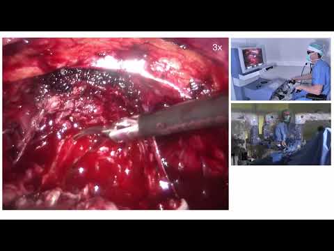 Senhance Prostatectomy