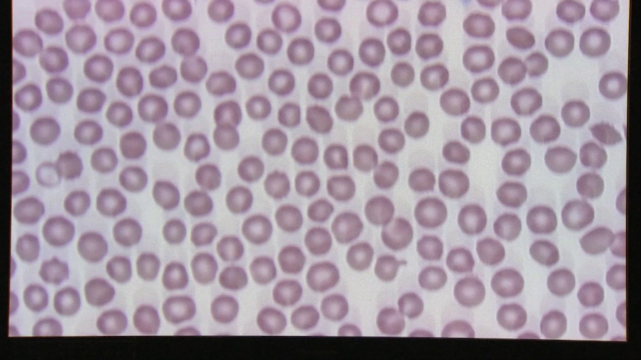 Blood Smear Evaluation