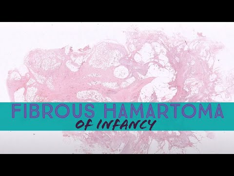 Fibrous hamartoma of infancy (dermpath dermatology dermatopathology soft tissue pathology)