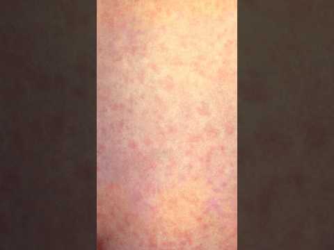 Measles symptoms and complications explained | UC Davis Health Tips