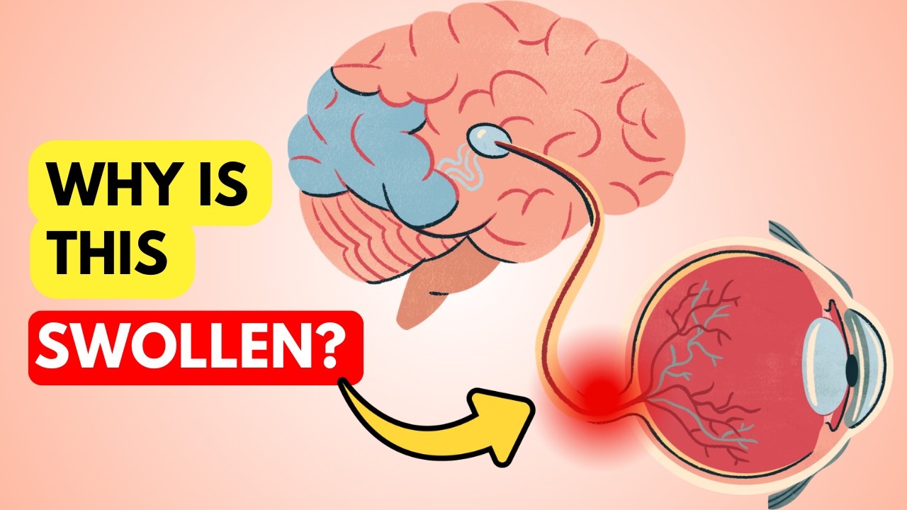 Papilledema: When High Brain Pressure Threatens Your Vision