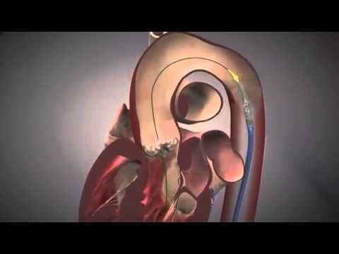 Transcatheter Aortic Heart Valve TAVI | NEWZNEW