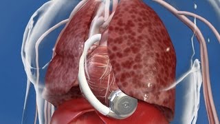 Left Ventricular Assist Device (LVAD) | Stanford Health Care