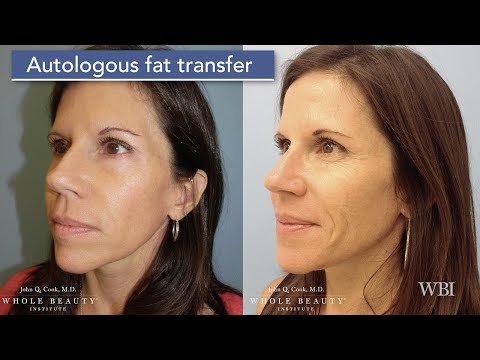 Facelift for a Younger Patient