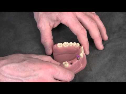 Straumann Implant Level Impressions