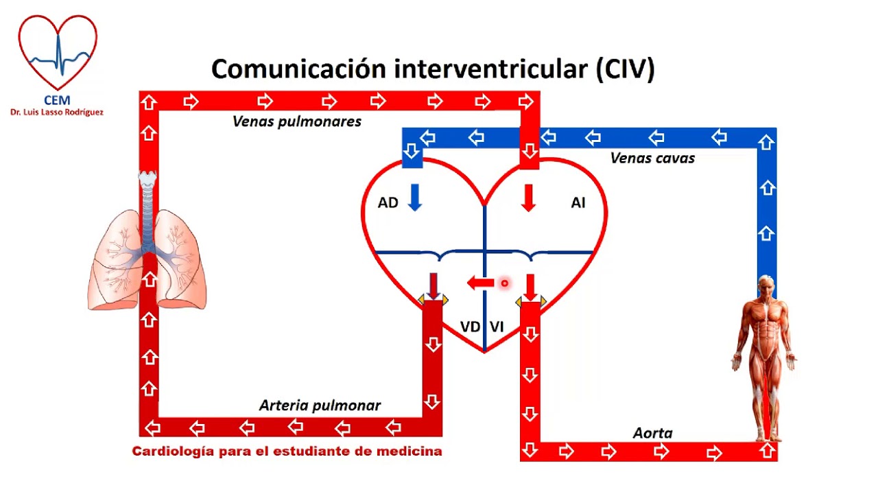 Circuito de la comunicación interventricular