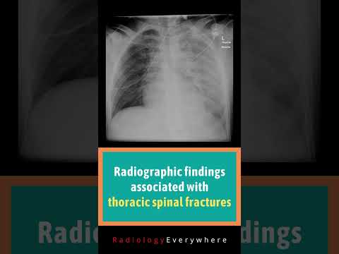 Radiographic findings associated with thoracic spinal fractures | 1000 Videos in 100 Days | Video 36