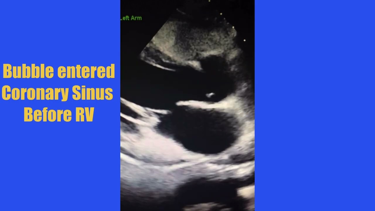 Persistent Left Superior Vena Cava (PLSVC)