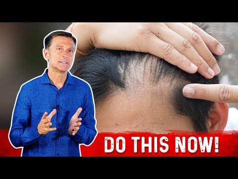 Receding Hairline: Causes And Remedies – Dr.Berg