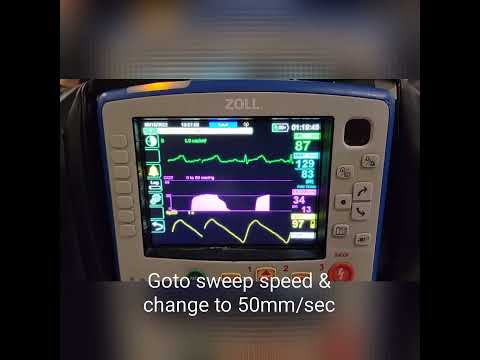 A Little-known Trick to Help YOU interpret ECGs in "Slow Motion"