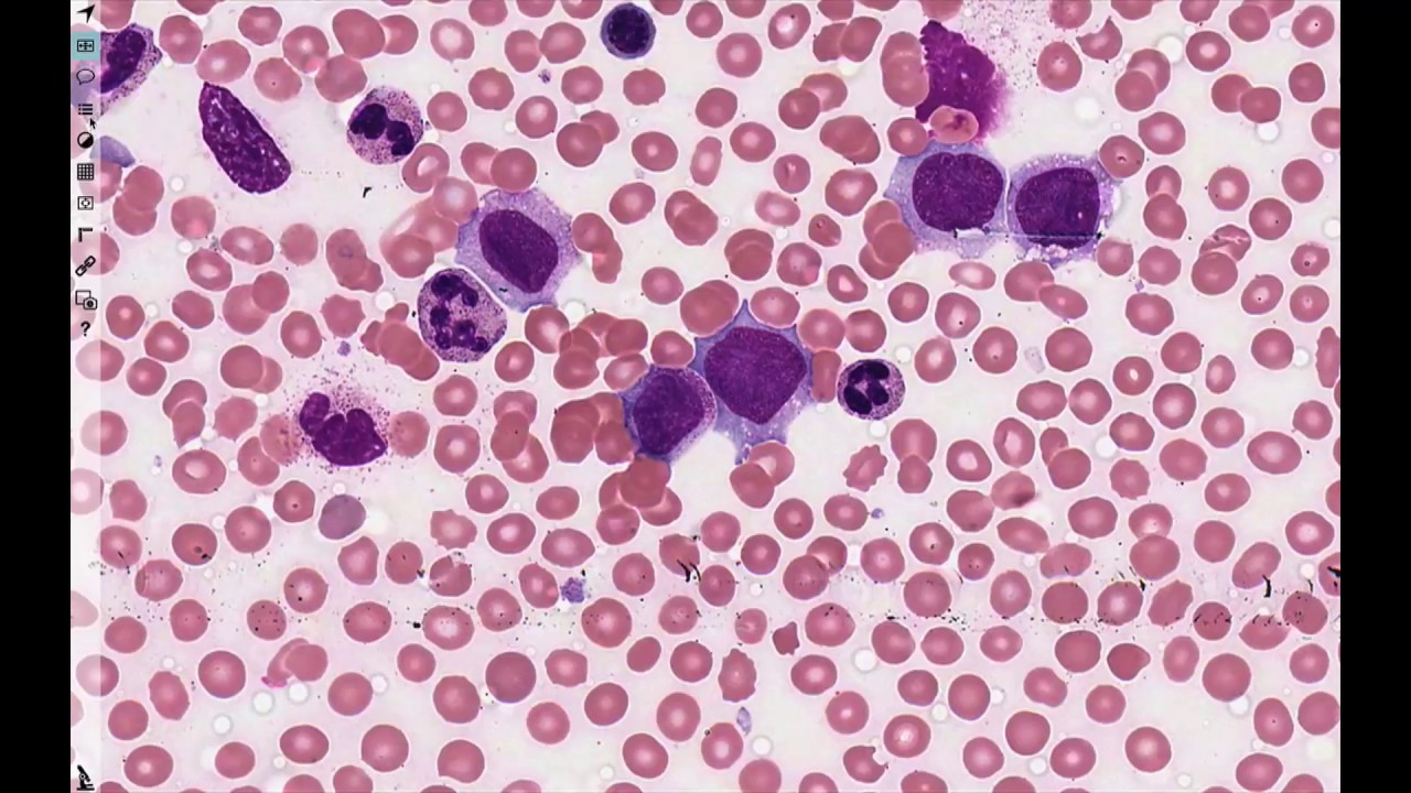 CAP Hematology Atlas: Virtual Peripheral Smears Overview