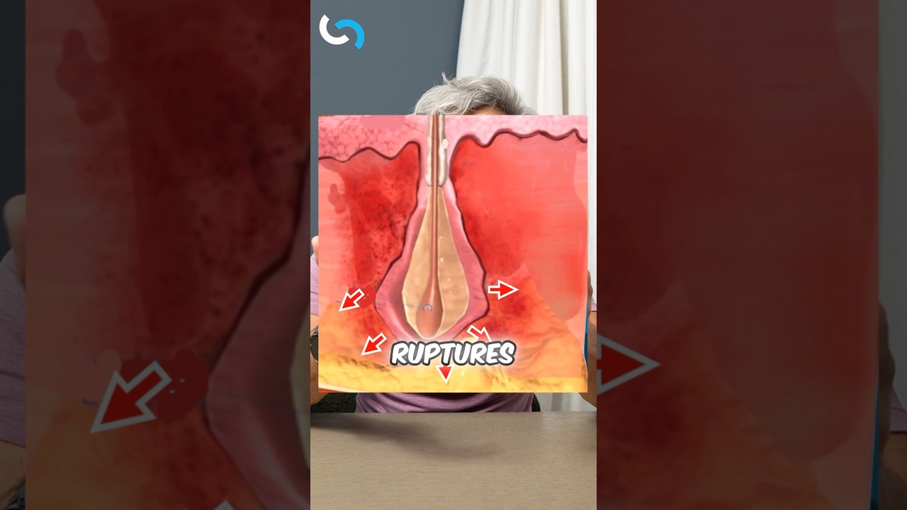 What is hidradenitis suppurativa?