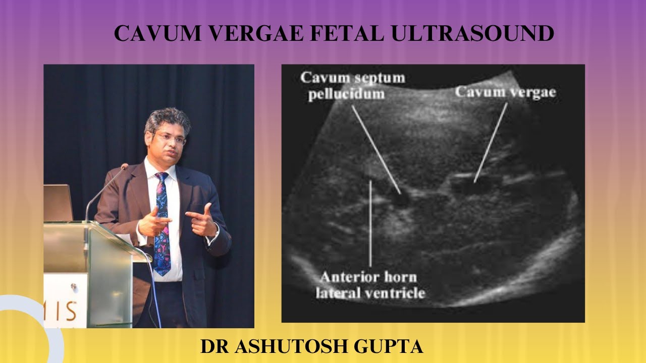 Fetal Cavum Vergae - Normal Variant Reassurance