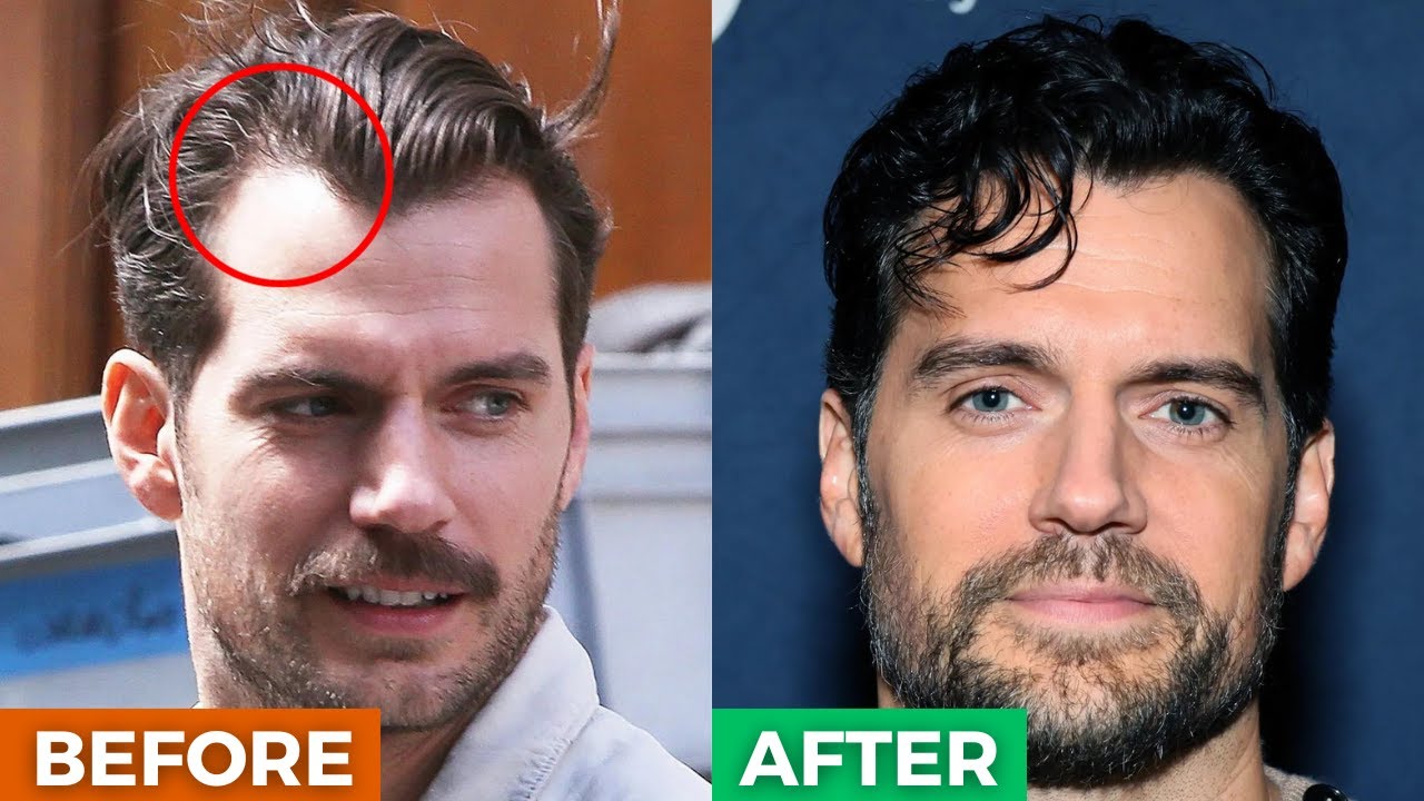 5 BRILLIANT Hairstyles To HIDE A Receding Hairline/Widows Peak
