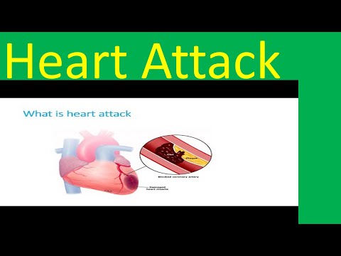 what is a heart attack/ myocardial infarction MI/ Acute coronary syndrome