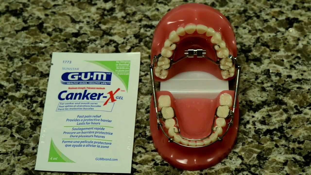 How The Crossbow Expander Or Class II Corrector Works And How To Care For It