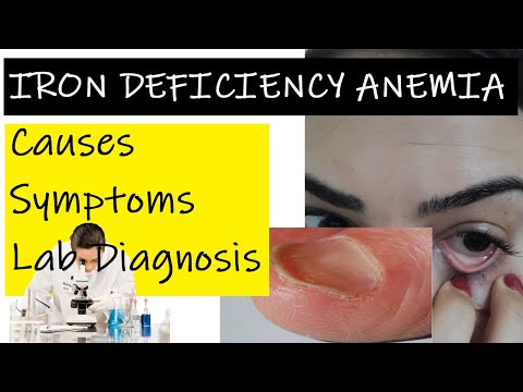 Iron deficiency anemia | Causes | Symptoms | Lab diagnosis