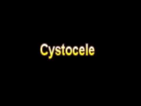 What Is The Definition Of Cystocele - Medical Dictionary Free Online