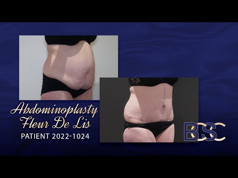 Fleur de Lis Abdominoplasty Post Weight Loss (Patient 2022-1024)