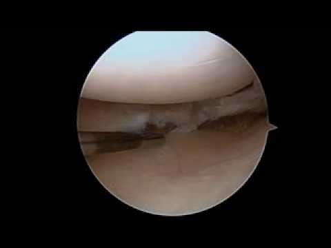 Arthroscopy of the Knee with Partial Meniscectomy - Daniel Quinn, MD