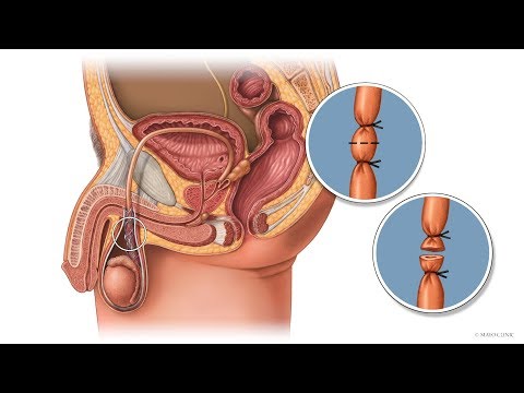 Mayo Clinic Minute: Why a vasectomy is a great option for birth control