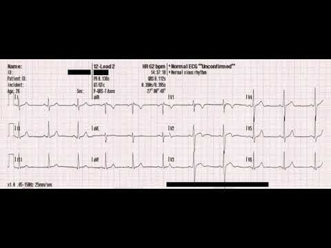 Electrocardiography | Wikipedia audio article