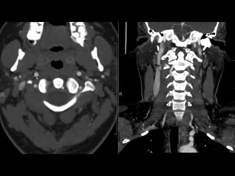CTA Head and Neck