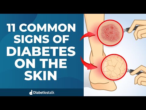 11 Common Signs of Diabetes on The Skin
